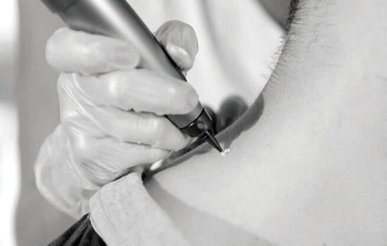 Best Benign Mole Removal Treatment in Huntingdon